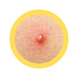 The 6 Types of Acne: How to Tell If Your Acne Is Mild, Moderate, or ...